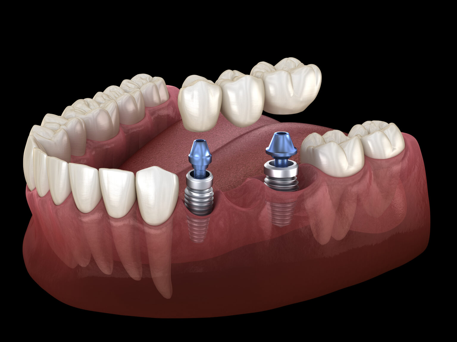 Implant Retained Bridge - Shadwell Dental Care | Dentist in Slaid Hill ...
